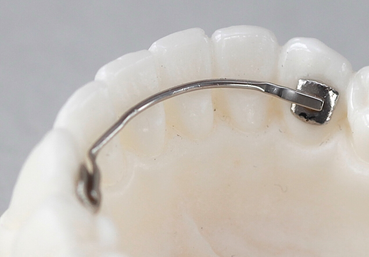Retainers - 4Kids Dental